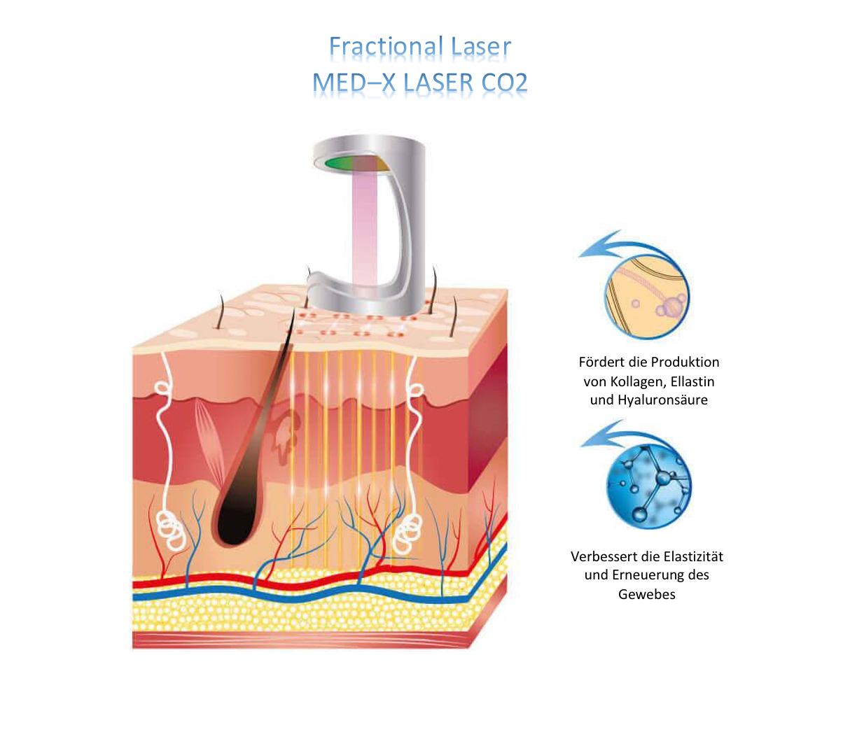 Fractional Laser zum günstige Preis kaufen